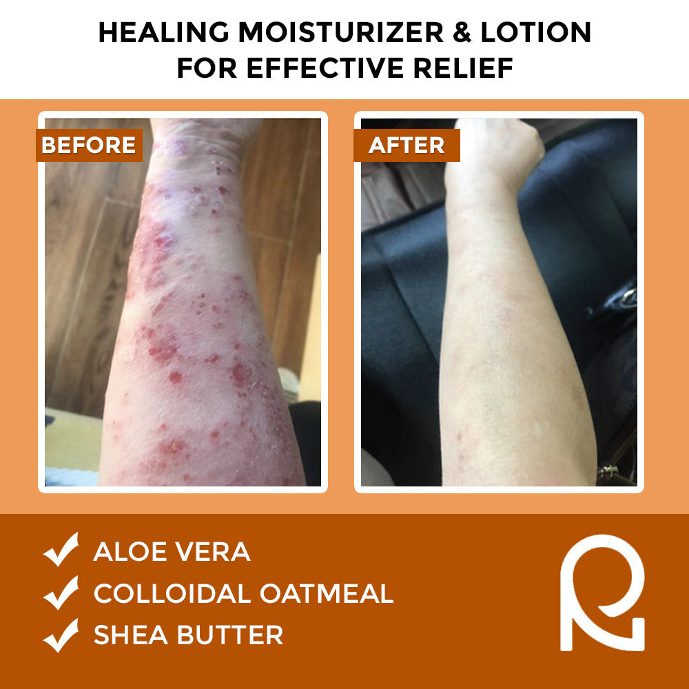 Oatmeal Eczema Lotion & Jojoba Oil, Bamboo & Aloe Vera Extract | All ...